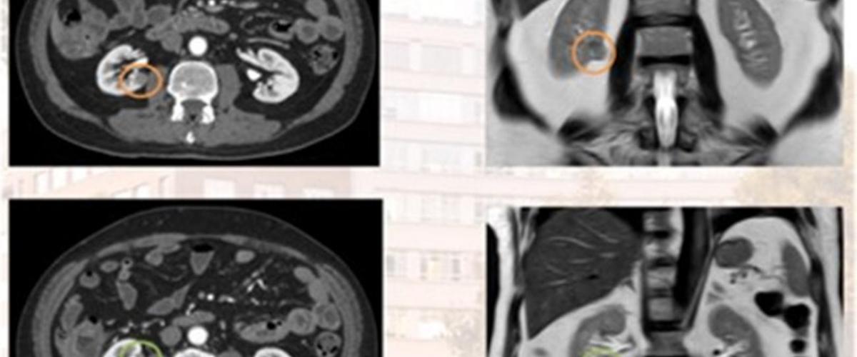 Cáncer de riñón: claves del diagnóstico y el tratamiento